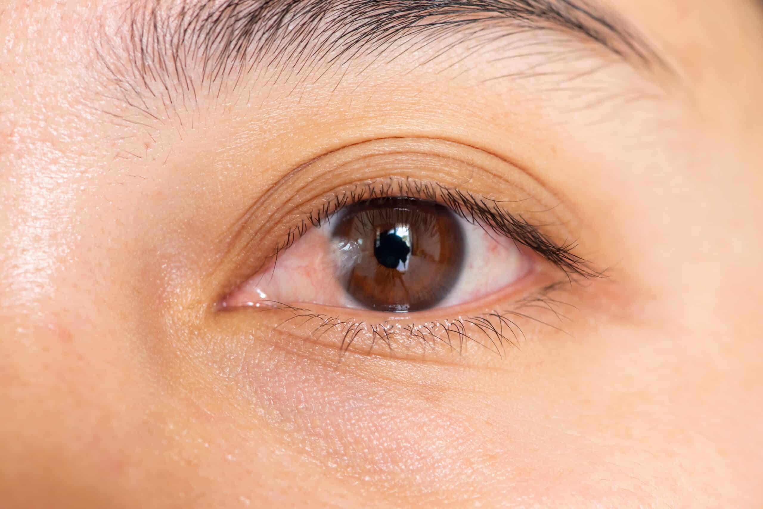 Pterygium St. Paul | Pterygium Treatment Woodbury, MN